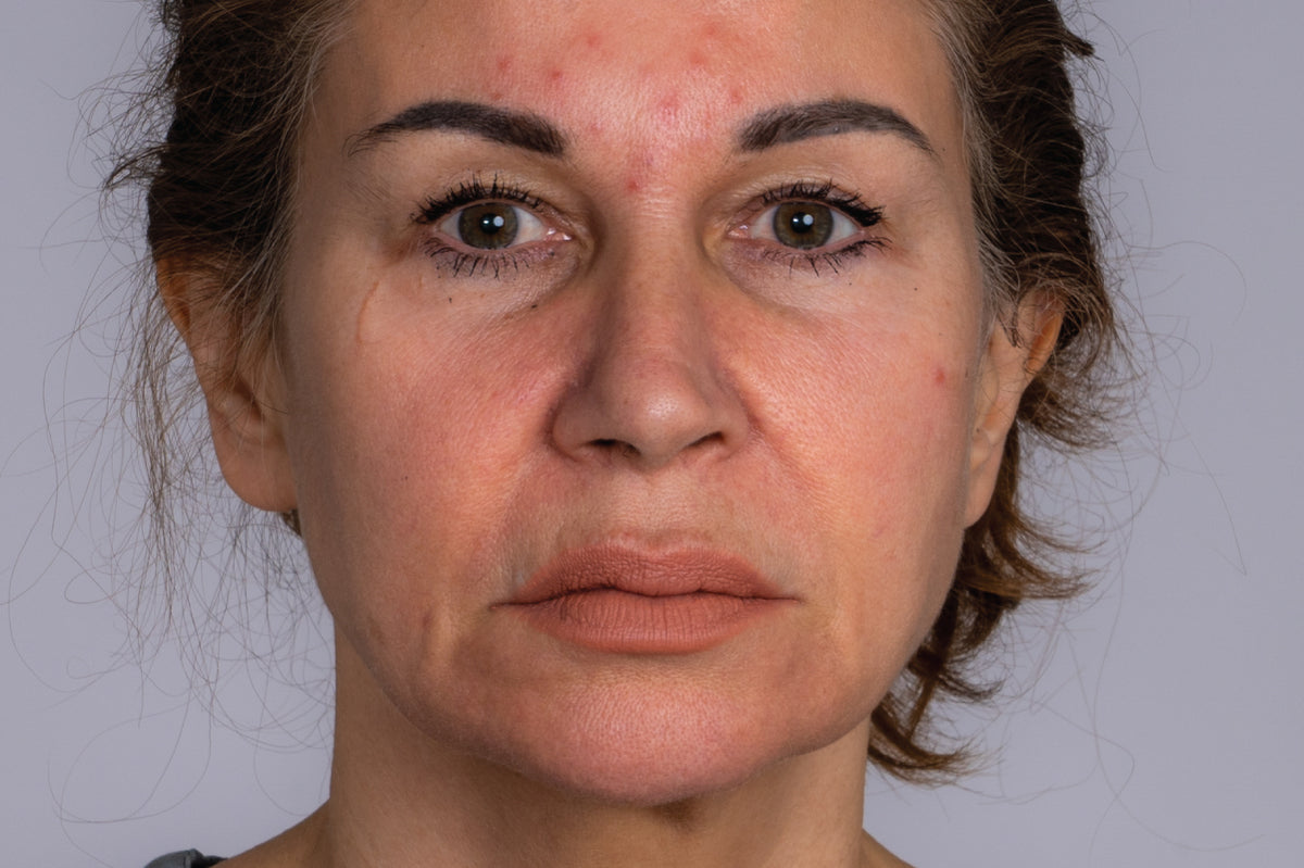 Silhouette Soft® Lift | Dr Sebagh Clinic