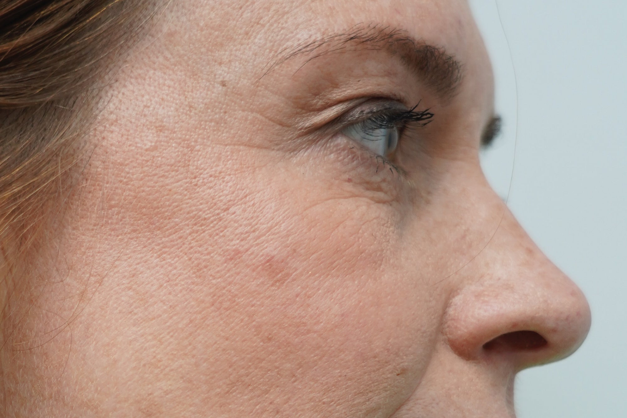 The Ultralift Eye Treatment | Dr Sebagh Clinic
